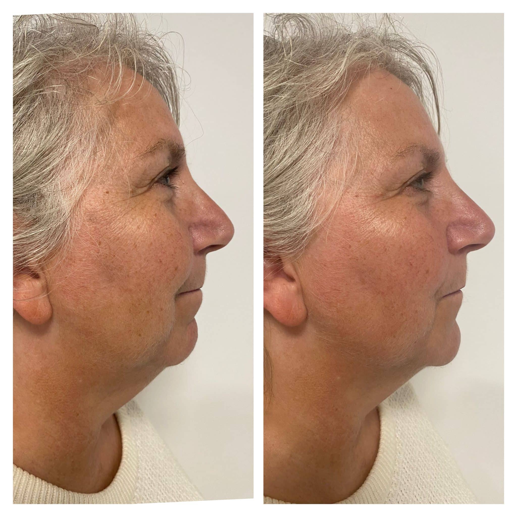 Bindweefselmassage met Natural Facelifting - Pedicurepraktijk Beauty ...